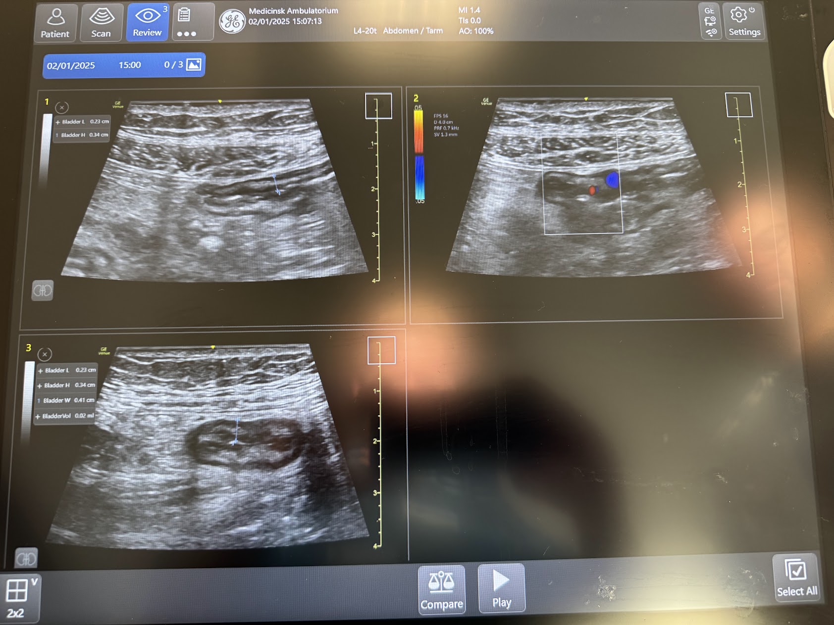 IBUS-SAS Score Calculator - Livets små ting